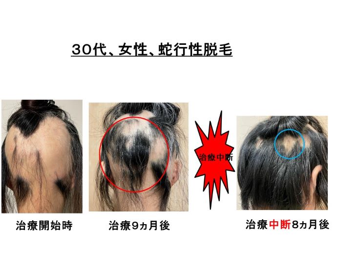 新型コロナワクチン副作用の円形脱毛症、改善するも治療中断で再発！ 患者様からの声・メディア掲載・クリニックからのお知らせ 名古屋kクリニック